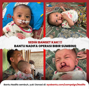 Bantu Nadifa Operasi Bibir Sumbing